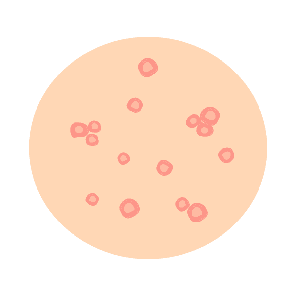 Svamp i underlivet (candidainfektion) - Doktera